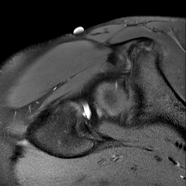 Radiology Cases: Iliacus Muscle Contusion with Submuscular Haemorrhage
