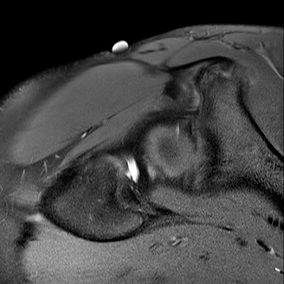 Radiology Cases: Iliacus Muscle Contusion with Submuscular Haemorrhage