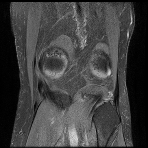 Radiology Cases: Chondrocalcinosis