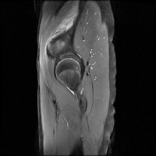 Radiology Cases: Rectus Femoris Partial Tear and Sub-Iliacus Haemorrhage