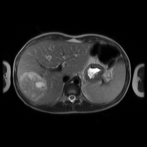 Radiology Cases: Pyogenic Liver Abscess