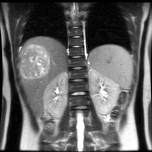 Radiology Cases: Pyogenic Liver Abscess