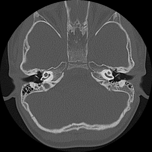 Radiology Cases: Mondini malformation