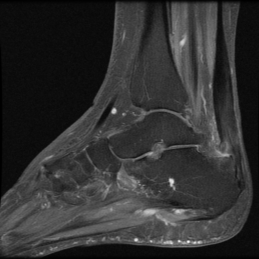 Radiology Cases: Haglund's Syndrome