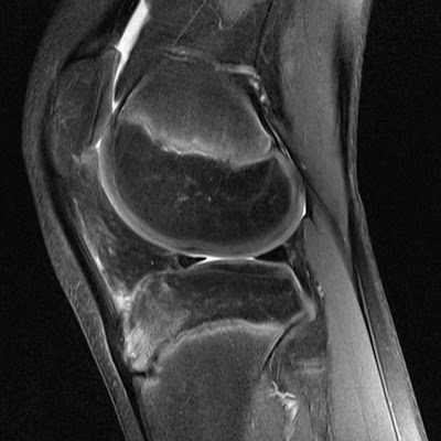 Radiology Cases: Osgood Schlatter Disease