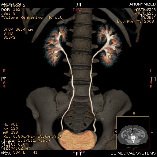 Diagnostico por Imagenes: Urotomografía