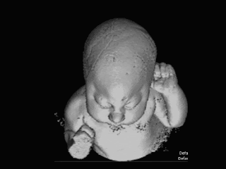 My Radiology World: "Trigonocephaly"
