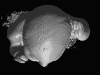 My Radiology World: "Trigonocephaly"
