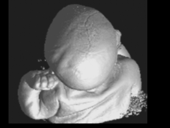 My Radiology World: "Trigonocephaly"