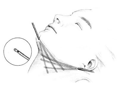 Clínica Plenna Cirurgia Plástica - Florianópolis: Lipoaspiração de ...