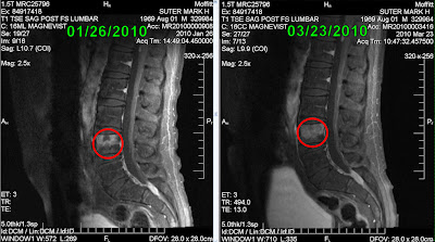 Tumor: Tumor Lower Back