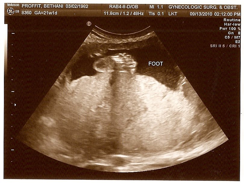Three Ring Circus: 21 weeks (Ultrasound and check up)
