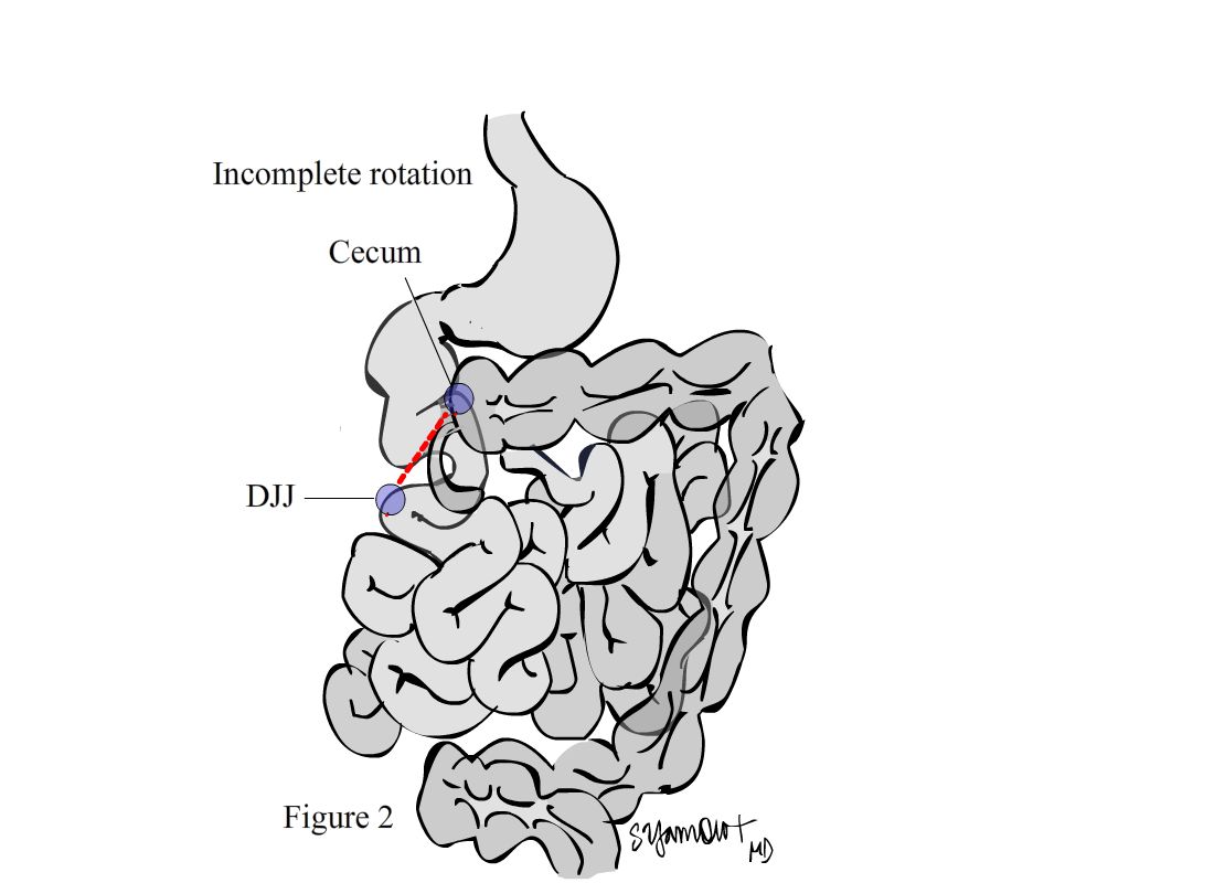 Pediatric Surgery Zone: Rotational anomalies of the midgut... what's what?