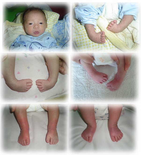 Little Flower Projects: The Miracle of Ponseti