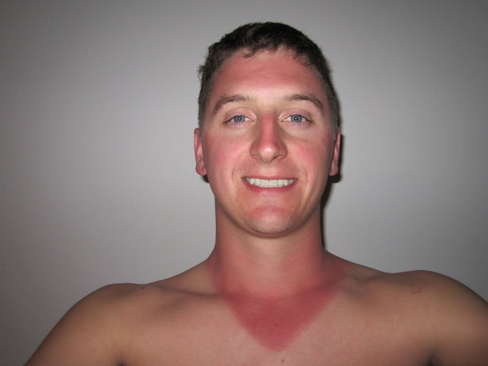 Here Goes Nothing: Denver: My Welcome to Miami Gift....Sunburn