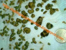 Limpieza Hepatica:Barro biliar y pancreatitis: Limpieza Hepática ...