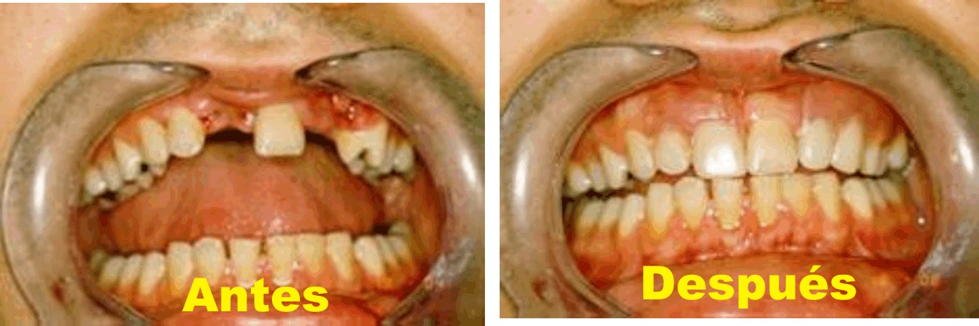 Odontologia Integral: Prótesis Parcial Flexible