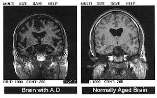 Lynne's CT & MRI Pathology Blogs: Alzheimer's Disease