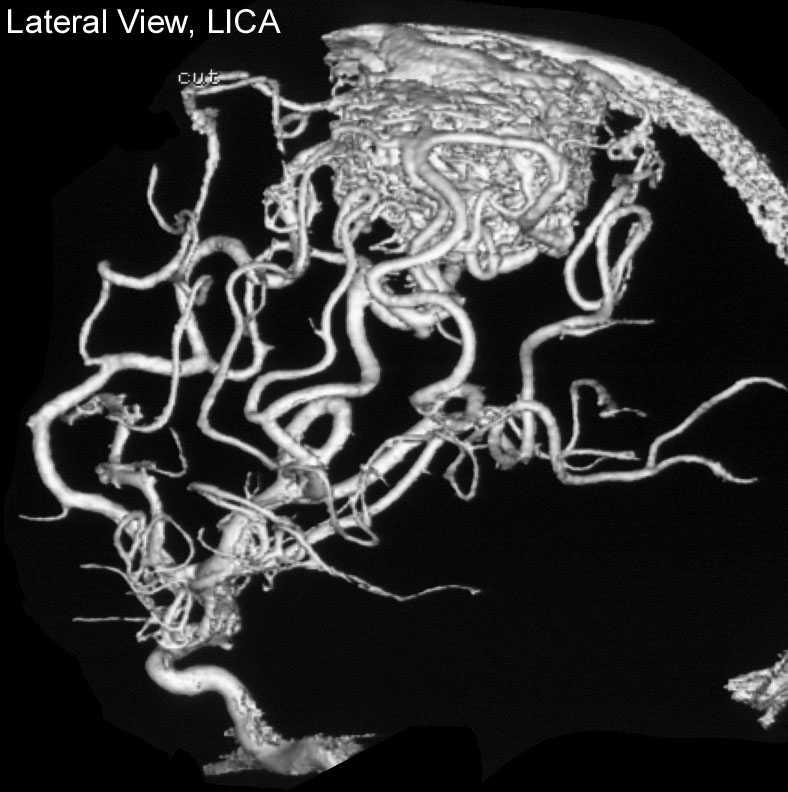 Lynne's CT & MRI Pathology Blogs: Arteriovenous Malformation (AVM)
