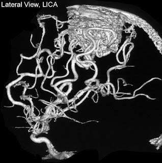 Lynne's CT & MRI Pathology Blogs: Arteriovenous Malformation (AVM)