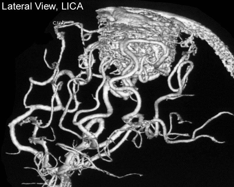 Lynne's CT & MRI Pathology Blogs: Arteriovenous Malformation (AVM)