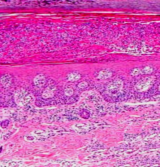 Dermatopathology Case 78
