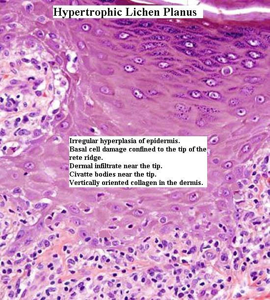 Answer of Dermatopathology Case 94