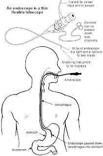 Surgicomania: Peptic ulcer disease and Gastric Carcinoma