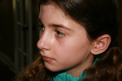 Madeline's JDM Story: Updated pics of Madeline's JDM rash