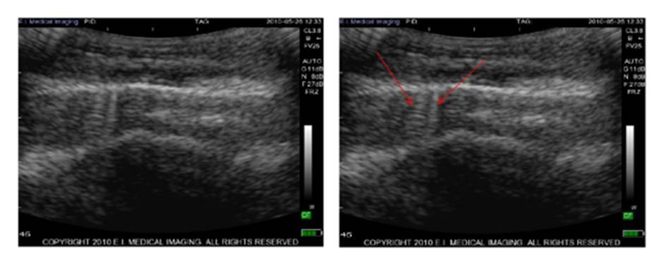 BÀI SOẠN VỀ SIÊU ÂM CHẨN ĐOÁN: A-LINES, B-LINES and AIR ARTIFACTS