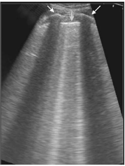BÀI SOẠN VỀ SIÊU ÂM CHẨN ĐOÁN: A-LINES, B-LINES and AIR ARTIFACTS