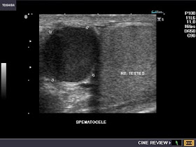 Spermatocele Ultrasound