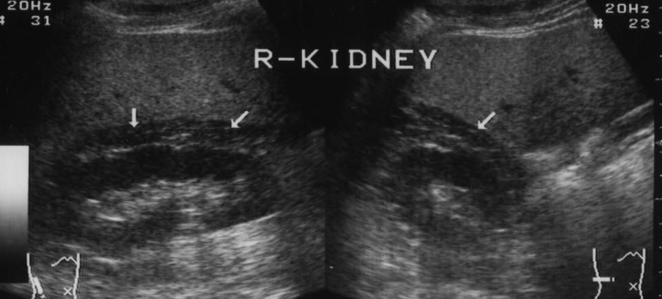 cochinblogs: A sonographic picture review of renal pathology: