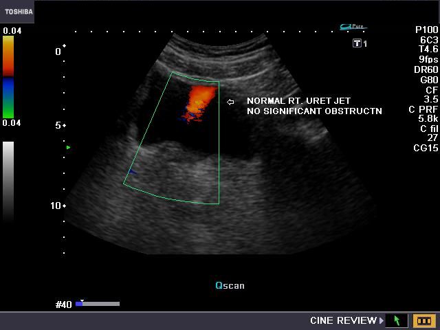 cochinblogs: Non obstructive Vesico-ureteric junction calculus