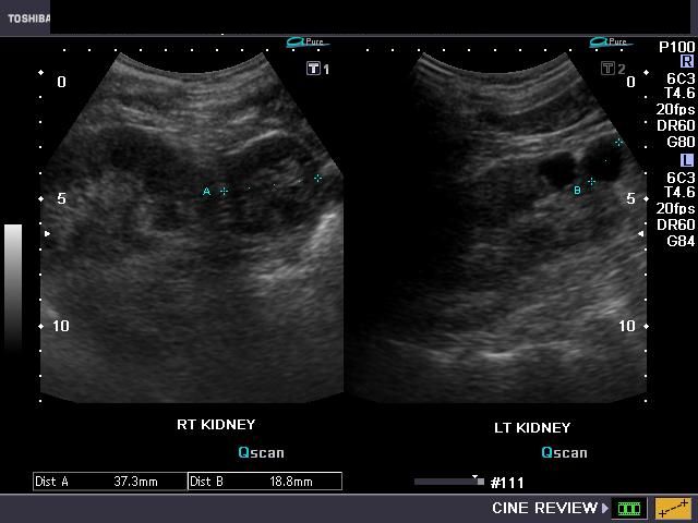 cochinblogs: An interesting case of mass in Riedel's lobe of liver
