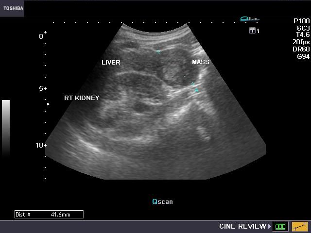 cochinblogs: An interesting case of mass in Riedel's lobe of liver
