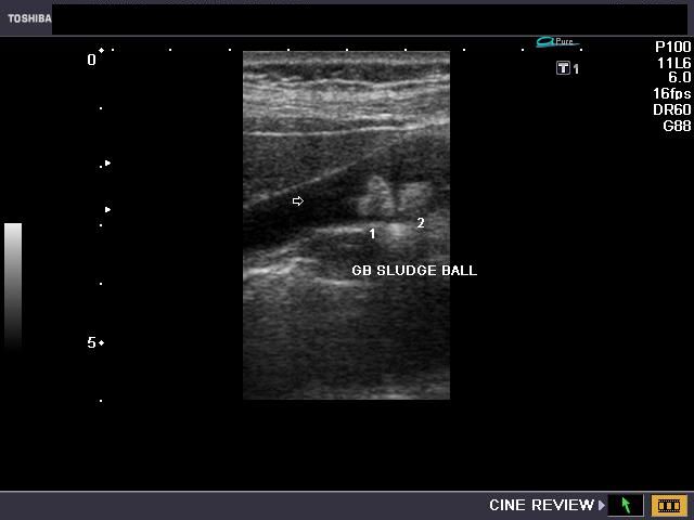 Tips On Health: Sludge balls in the Gall bladder: