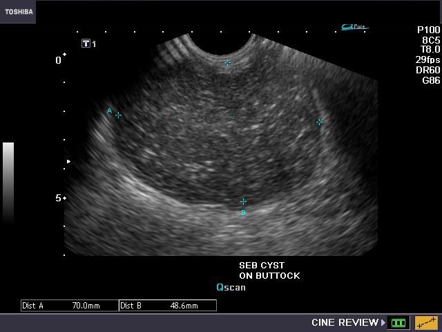 sebaceous cyst ultrasound images