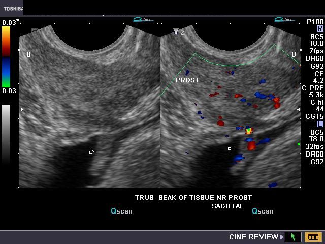 cochinblogs: Urinary bladder polyp:
