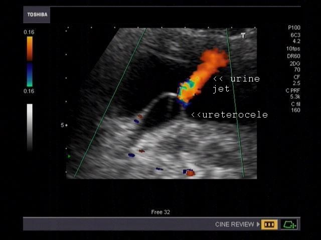 cochinblogs: Ureterocele with ureteric jet: