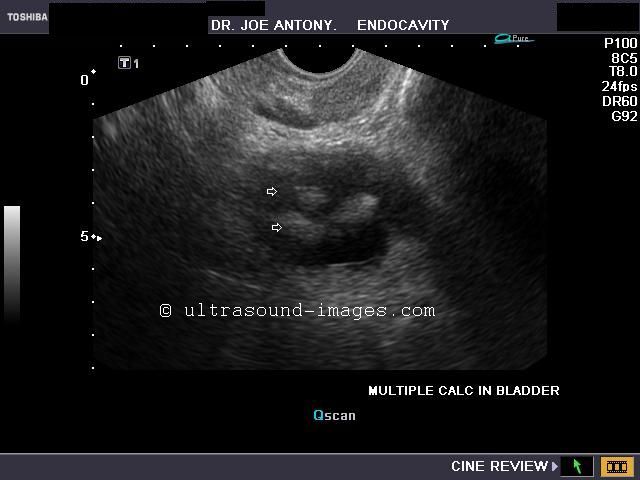 TRUS (transrectal ultrasound) imaging of bladder calculi: ~ Ultrasound ...