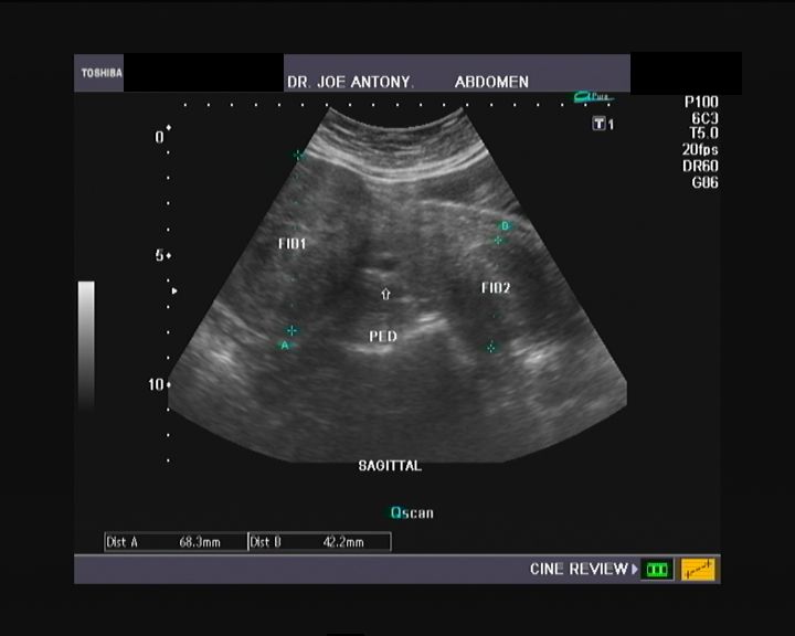 cochinblogs: Fibroids of the uterus (leiomyoma):