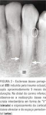 BLOG RDO RADIOLOGIA ODONTOLÓGICA: Trauma Oclusal