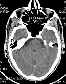 Anévrysme calcifié du tronc basilaire