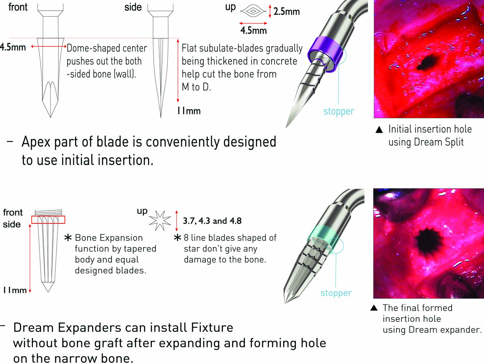 IBS Implant: Innovative IBS Implant System