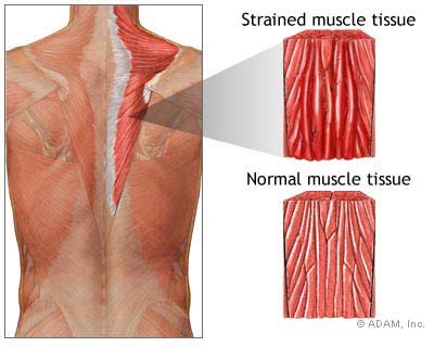 manda manda mandaaa.: Grade 3 Muscle Strain