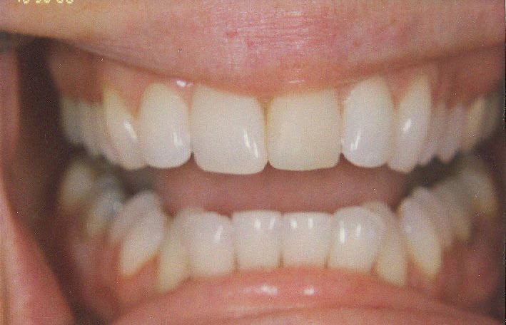 Bellevue Cosmetic Dentist Choosing the Best Dentistry: BELLEVUE ...