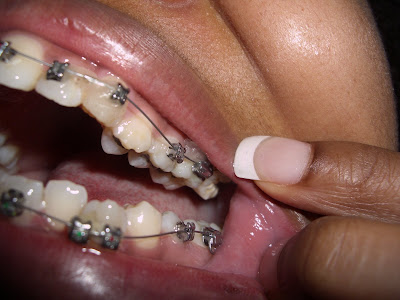 Train Track Journey: Braces from Consult to Day 2 Journey