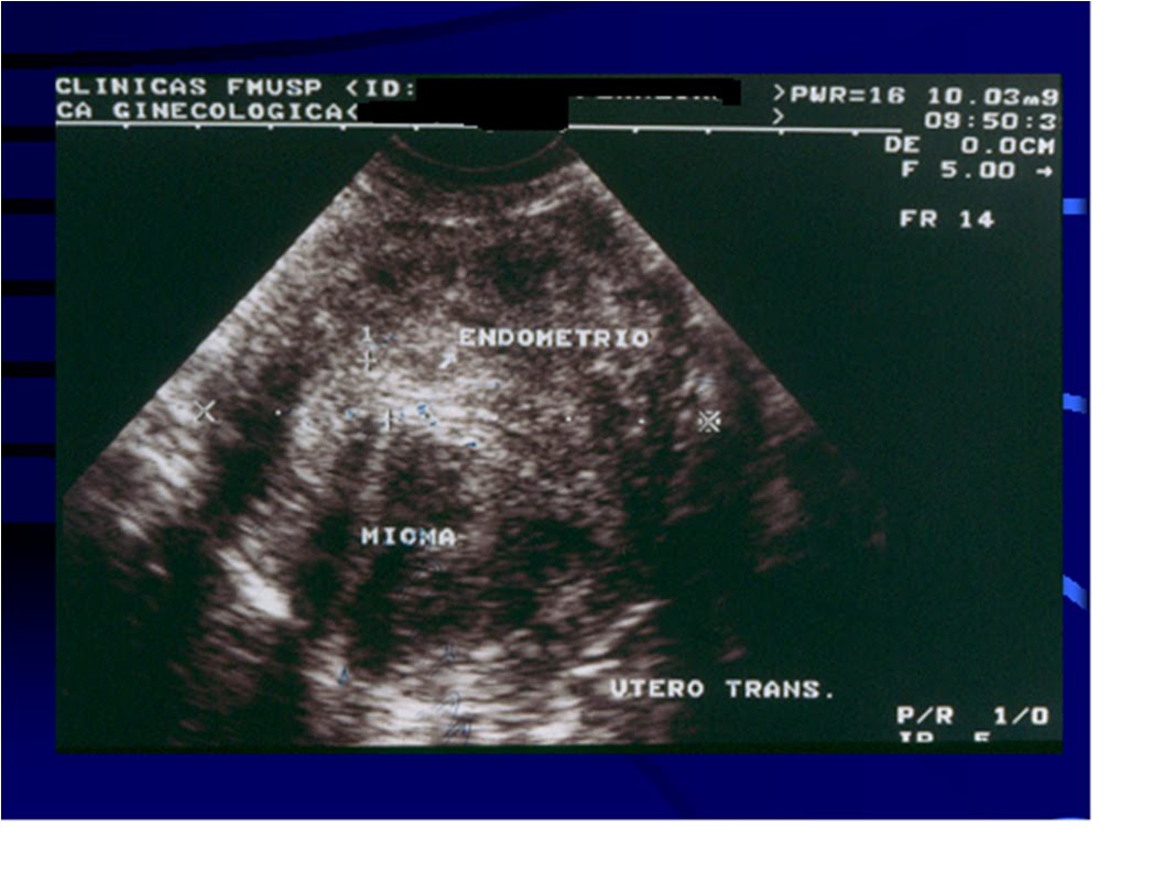 GinecoUSP: Mioma Uterino
