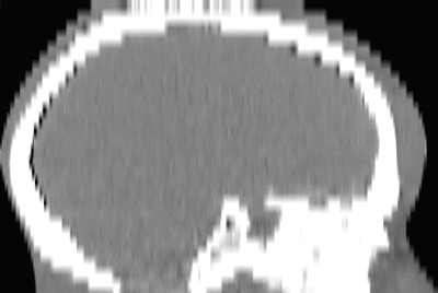 CT PHYSICS2009: ARTIFACTS IN SPIRAL CT